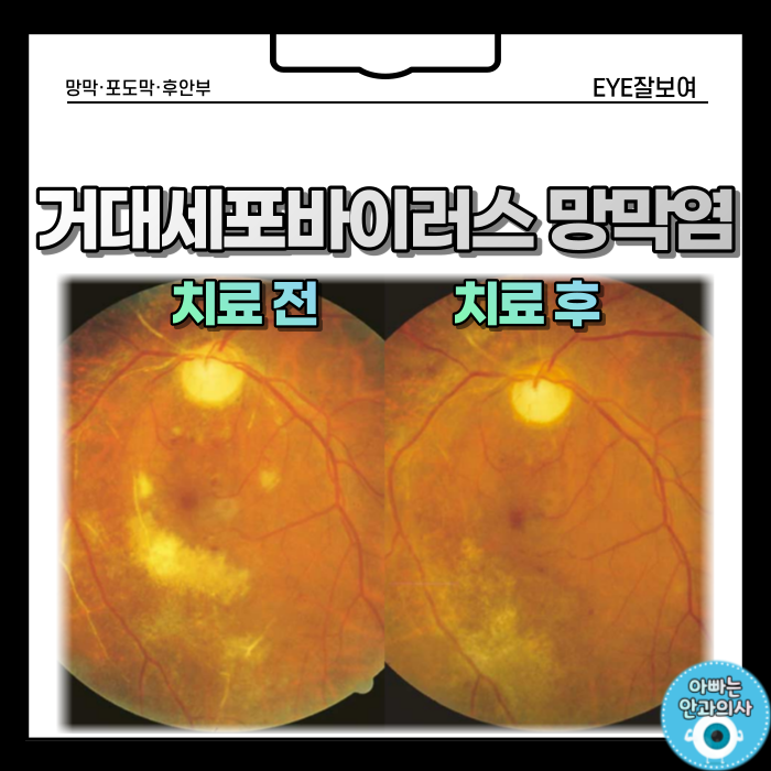 거대세포바이러스 망막염 치료 : 네이버 블로그