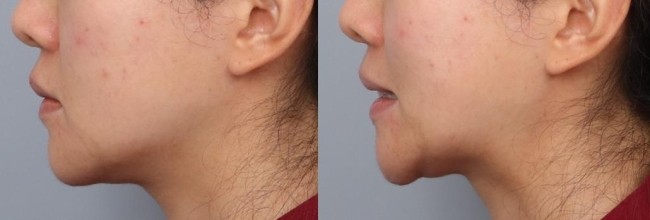 표정지을 때 생기는 마녀턱 교정 (dynamic chin ptosis, 표정 마녀턱) : 네이버 블로그