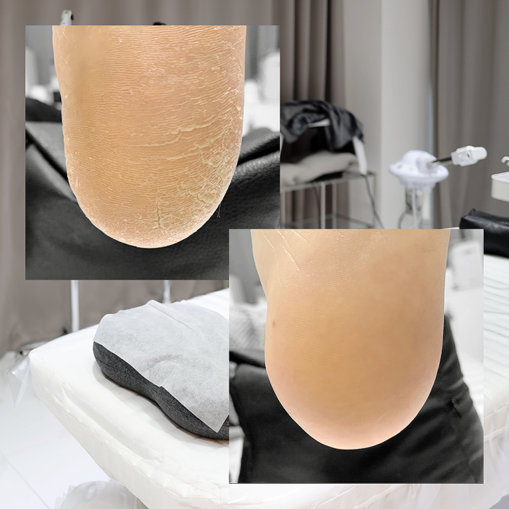 청주 패디플래닝 강서동 포유뷰티 발각질제거 진작에 할걸 네이버 블로그