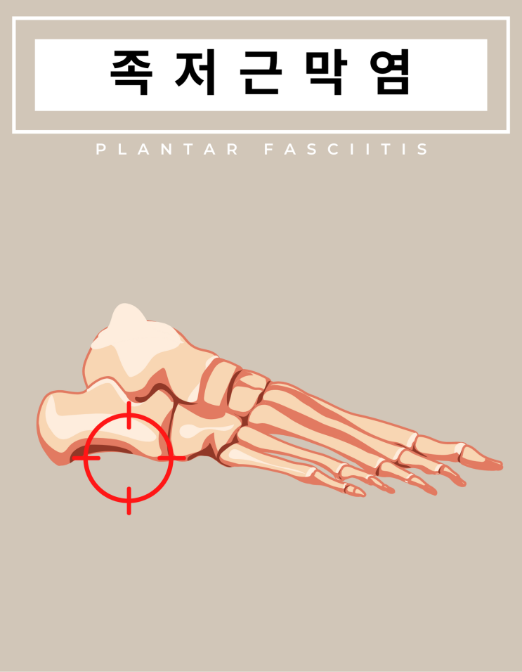 상일동역필라테스고덕필라테스 족저근막염과 필라테스 네이버 블로그