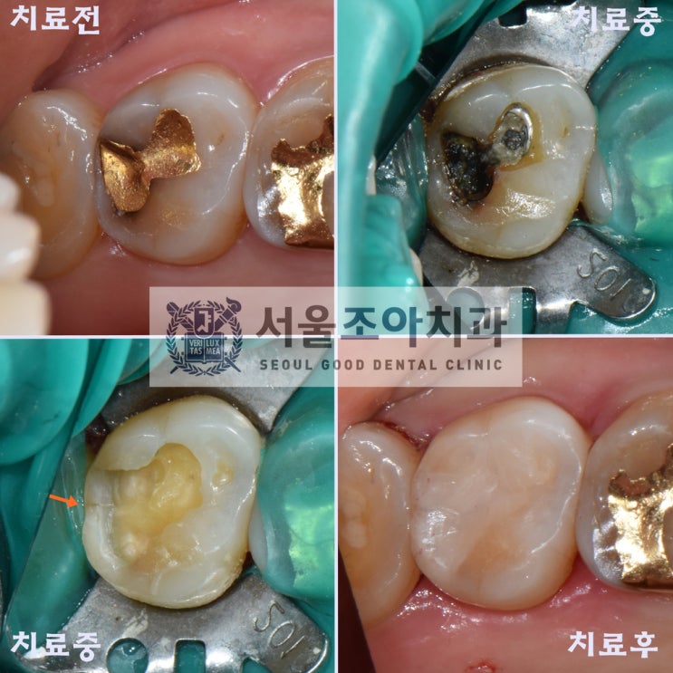 골드인레이 하방 이차충치 및 크랙치아의 레진빌드업 증례 걸포동치과 걸포동 충치치료 네이버 블로그