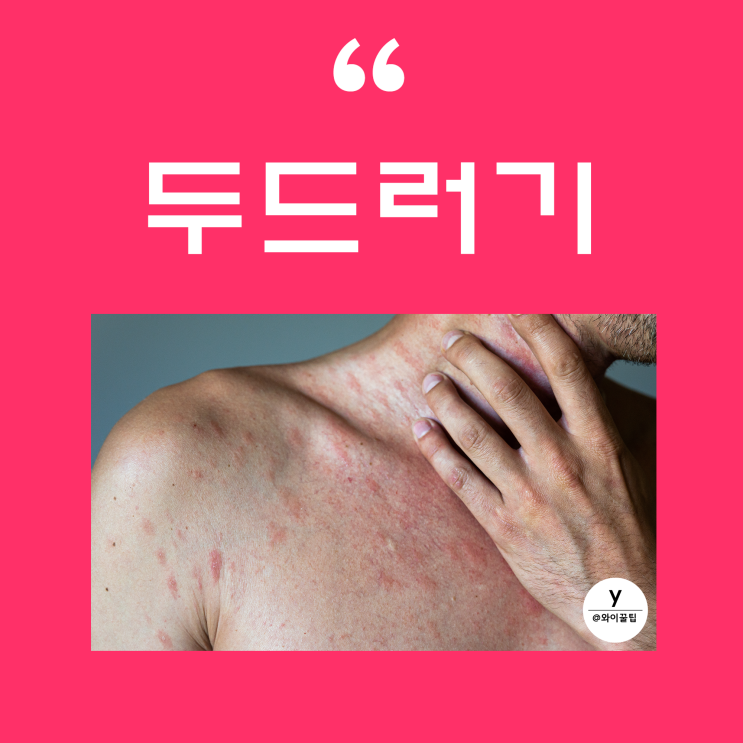 두드러기 원인 증상 치료 약 연고 피부 팔 배 손등 목뒤 전신 얼굴 몸에 손바닥 허벅지 응급처치 만성 급성 열 네이버 블로그