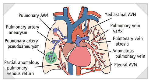 폐동정맥기형 색전술 (Pulmonary AVM Embolization) : 네이버 블로그