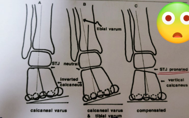 Rearfoot varus/Forefoot varus : 네이버 블로그
