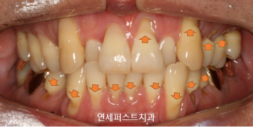 치아가 패여서 시린 치경부 마모증 치료 네이버 블로그