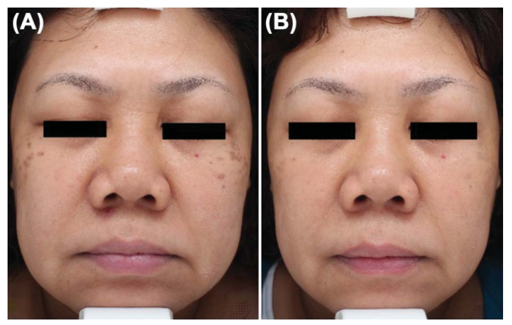 ABNOM(양측성 오타모반, 호리모반) 의 레이저 치료 : 네이버 블로그