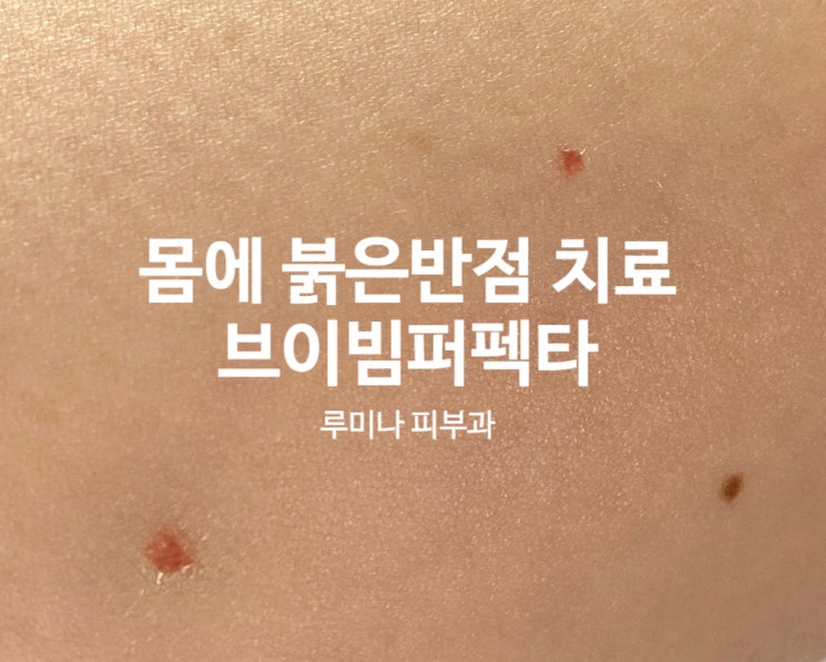 성복동피부과몸에 붉은반점 체리혈관종 치료 브이빔퍼펙타 네이버 블로그