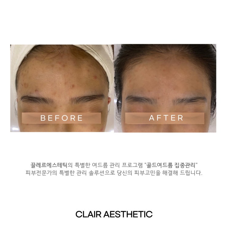 여드름 피부관리 전문 울산에스테틱 끌레르에스테틱 다양한 솔루션으로 트러블피부 고민을 날려 버리세요 네이버 블로그