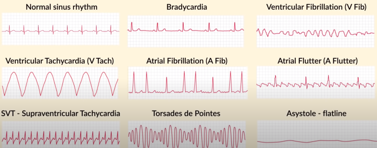 NCLEX EKG 리듬 시험 최다빈출 모음 9종세트 : 네이버 블로그