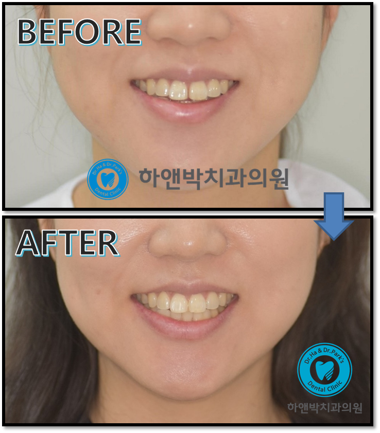 두 번째 재교정 앞니가 점점 더 벌어짐 교정치료 후 재발 치아교정 다시 하기 인천 앞니 부분교정 용현동 치과