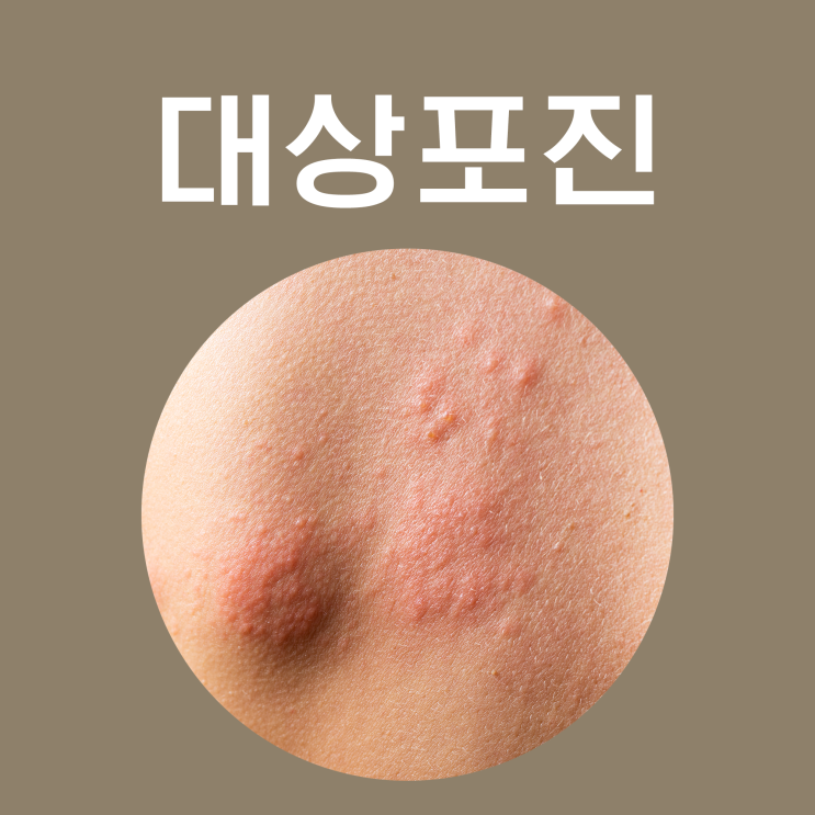 대상포진 원인 증상 초기증상 치료 약 백신 예방접종 눈 얼굴 흉터 엉덩이 후 신경통 병원 항바이러스제 수두예방접종 네이버 블로그
