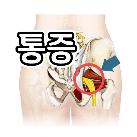 좌골신경통 치료 이상근증후군 논문으로 보는 이상근 스트레칭 효과 네이버 블로그