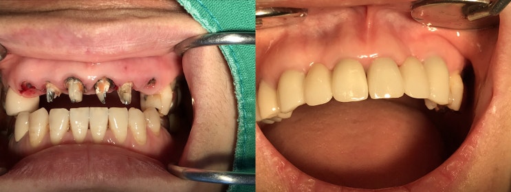 Socket Shield Technique - 방패기법 - 발치후즉시 임플란트 식립 - Partial Extraction ...