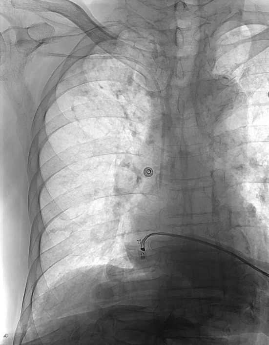 C-line catheter 설치술(대표적인 중심정맥관) : 네이버 블로그
