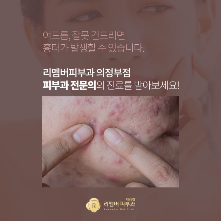 다가오는 여름 번들거리는 피비 개기름 마스크여드름 트러블 관리 레이저 치료 의정부 피부과 리멤버피부과 네이버 블로그