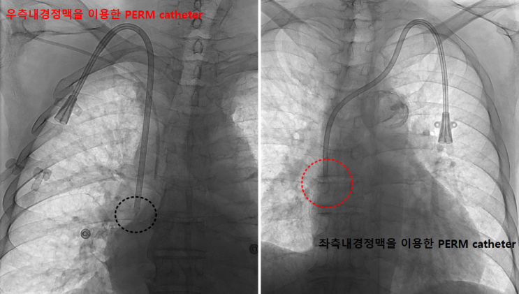 터널식 투석용카테터(Perm Catheter)-중심정맥관 : 네이버 블로그