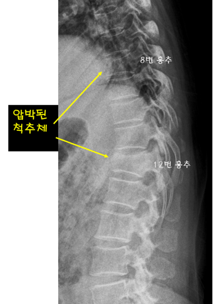 외상후 발상한 3군데 압박골절의 치료 척추체성형술 의정부 척추골절전문 네이버 블로그