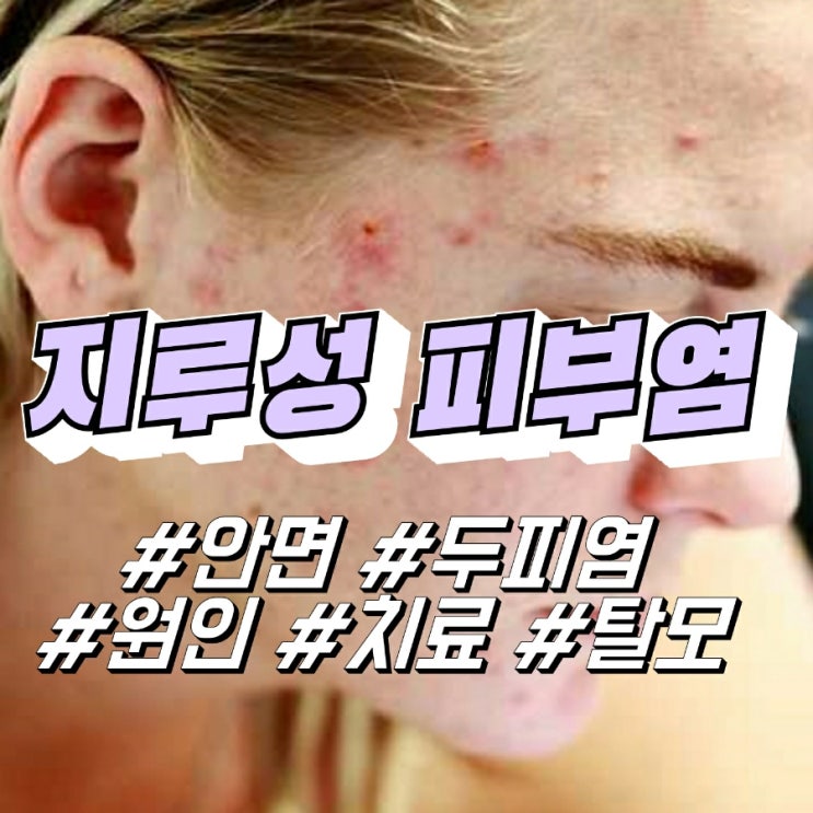 안면 지루성 피부염 증상 및 두피염 원인 치료 연고 탈모 네이버 블로그