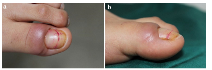 발톱이 거꾸로 파고드는 역행조갑(Retronychia) : 네이버 블로그