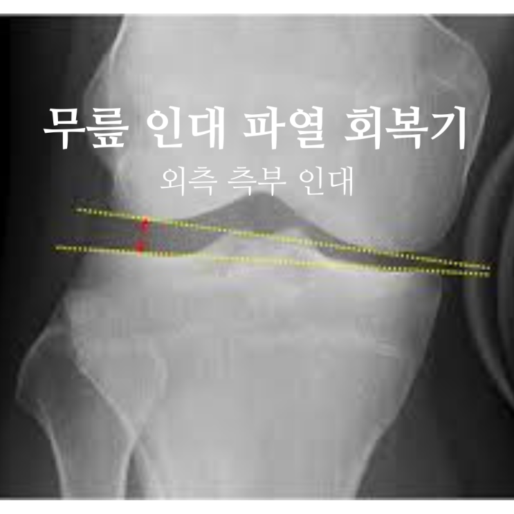 무릎 인대 파열 회복기 외측 측부 인대 네이버 블로그