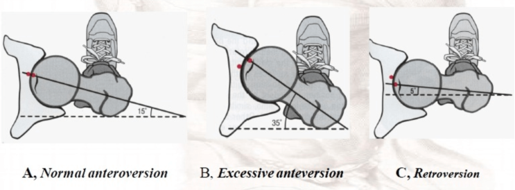 넙다리뼈 앞경사와 뒤경사 / anteversion,retroversion / craig's test : 네이버 블로그