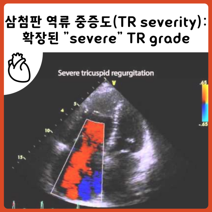 삼첨판 역류(삼첨판 폐쇄부전) 중증도(TR severity): 2017 ASE 가이드라인과 확장된(expansion ...