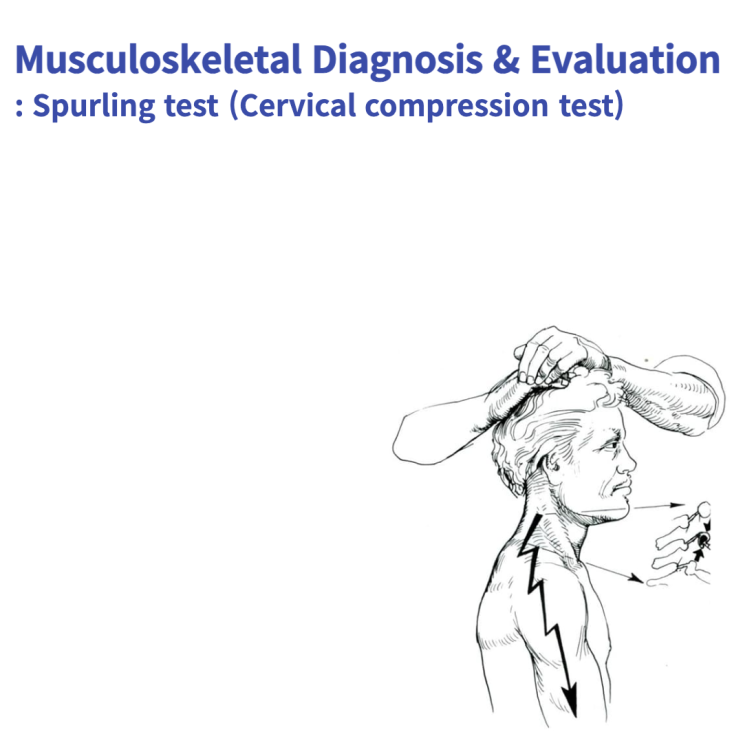 Spurling test (Cervical compression test) - 스펄링 검사 (목뼈 압박 검사) : 목뼈 신경병증 ...