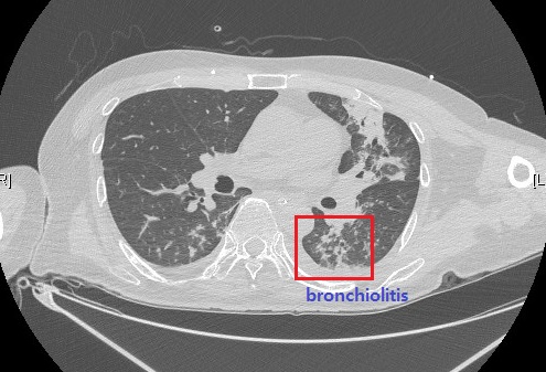 CT에서 bronchiolitis 그리고 tree-in-bud : 네이버 블로그