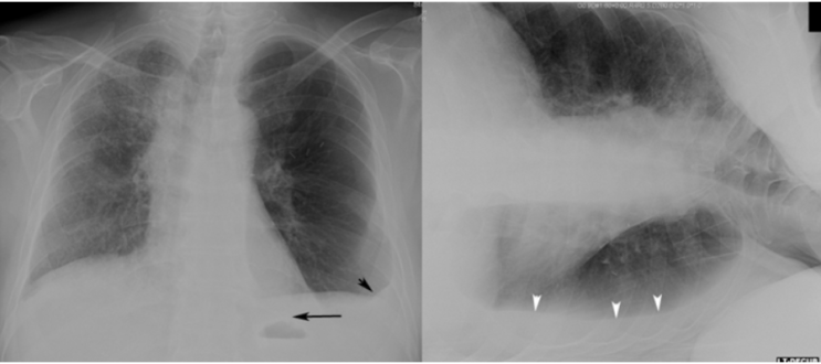 Pleural effusion (흉막 삼출) (exudate vs transudate), Thoracentesis. : 네이버 블로그