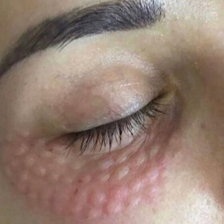 샤넬주사 리쥬란 엑소좀 비슷한듯 다른 스킨부스터 종류차이점 네이버 블로그