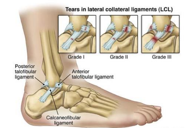 [논문리뷰] 발목 염좌 외측인대 손상 재활 방법 (Lateral Ankle Sprain / ATFL, CFL, PTFL ...