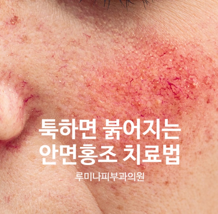 용인 상현동 상현역얼굴 붉은기 홍조치료 안면홍조 원인부터 확인 네이버 블로그