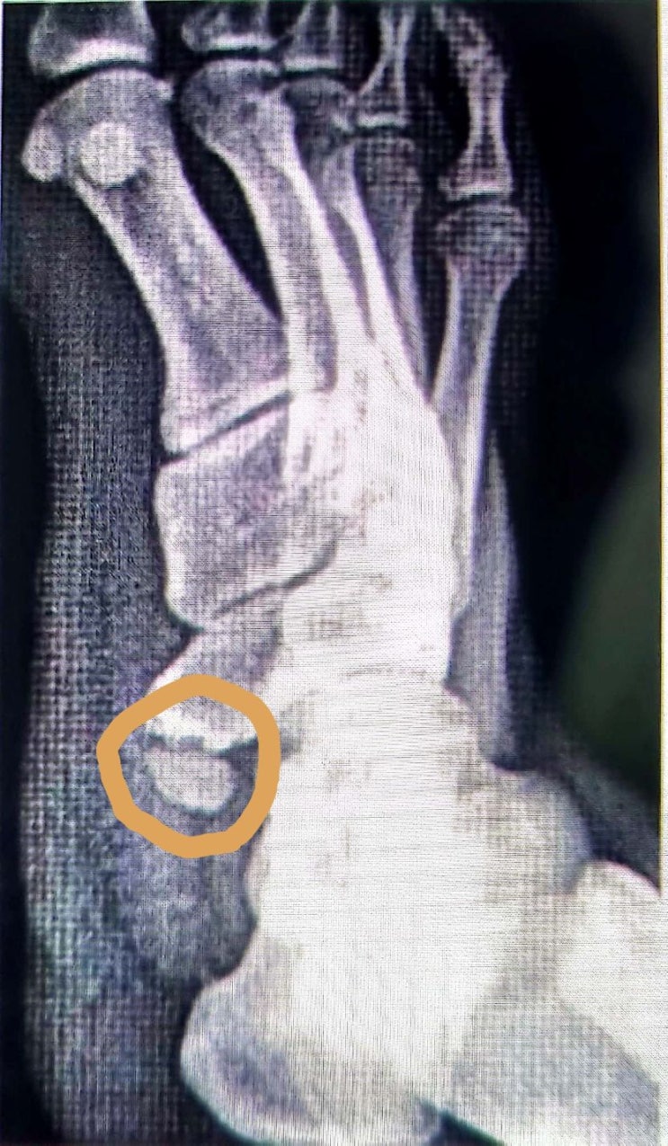 부주상골 증후군 (Accessory navicular bone syndrome) : 네이버 블로그
