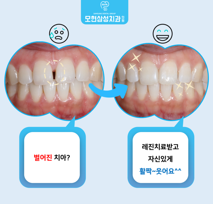 【모현삼성치과】 벌어진 앞니 치료받고 자신있게 활짝~ 웃어요 익산레진치료 다이아스테마 네이버 블로그