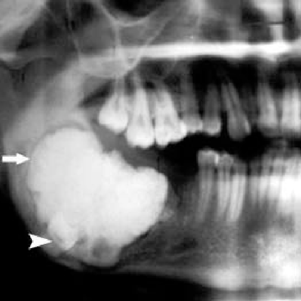 Ameloblastic Fibro-Odontoma or Complex Odontoma : 네이버 블로그