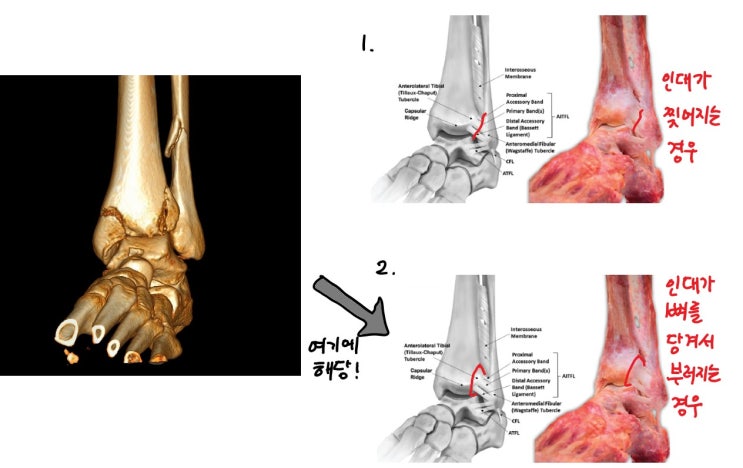발목 골절 양과 골절뼈는 두개 부러졌는데 골절은 3개 라구요tillaux Chaput Avulsion Fx