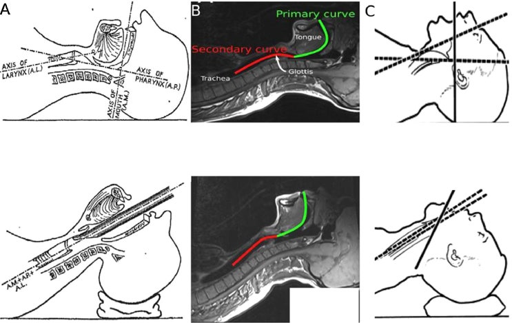 기도삽관intubation을 잘하기 위한 최적의 position (ft. sniffing position) : 네이버 블로그
