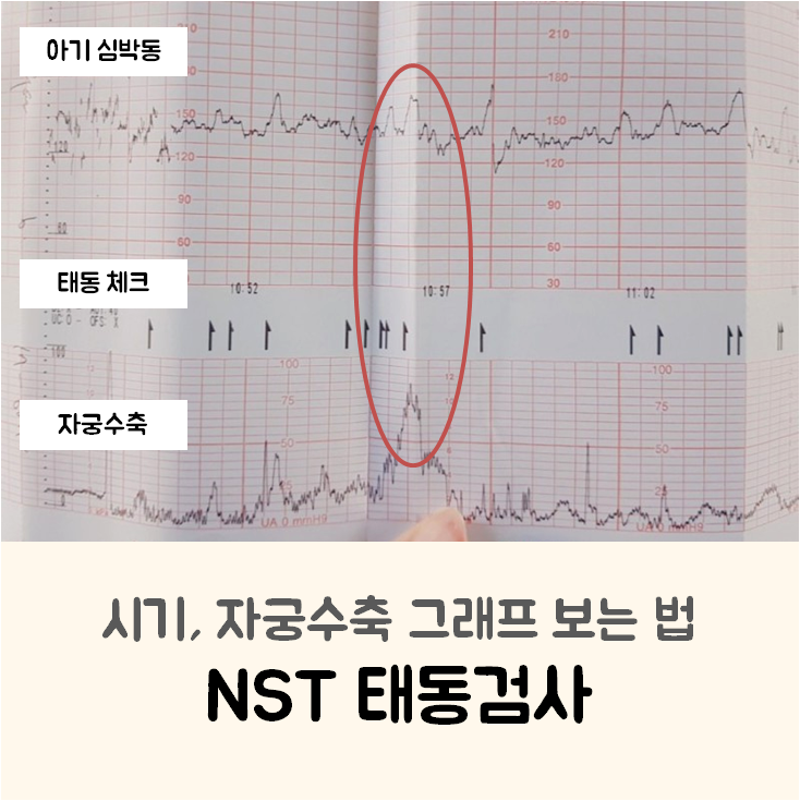NST 태동검사 시기와 비용, uc수치 자궁수축 그래프 보는 법 : 네이버 블로그