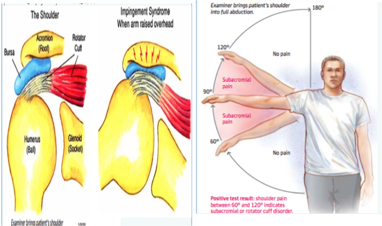 Subacromial Impingement : 네이버 블로그