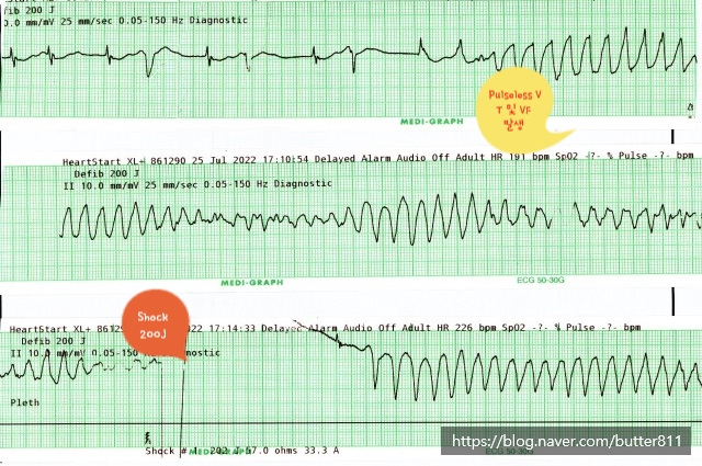 pulseless VT(심실빈맥) 및 VF(심실세동) case : 네이버 블로그