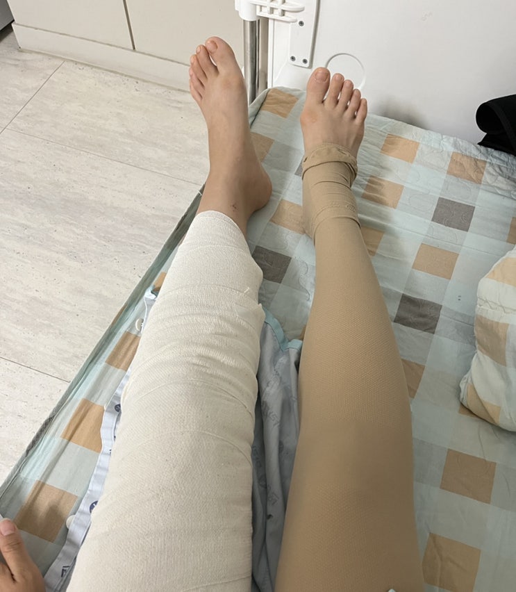 여자 전방 십자인대파열 후기 완전파열 수술 일반인o 운동선수축구 X 네이버 블로그
