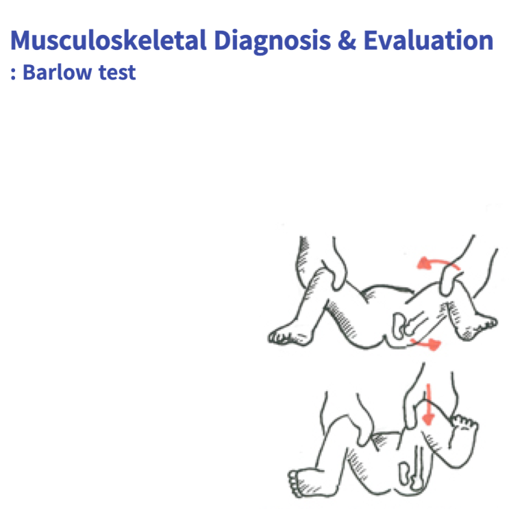 Barlow test : 바로우 테스트 - 선천성 엉덩관절 탈구 평가 : 네이버 블로그