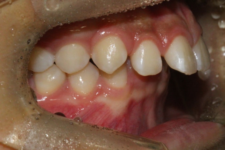Upper molar distalization(Wedging effect) : 네이버 블로그