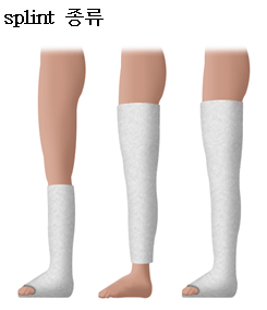 splint와 cast : 네이버 블로그