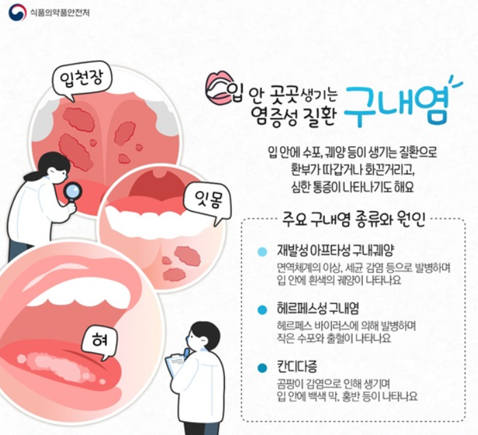 구강과 구인두의 양성 질환 1 재발성 아프타성 입안염구내염 백반증 편평태선 적색반홍반증 지도혀 고랑혀