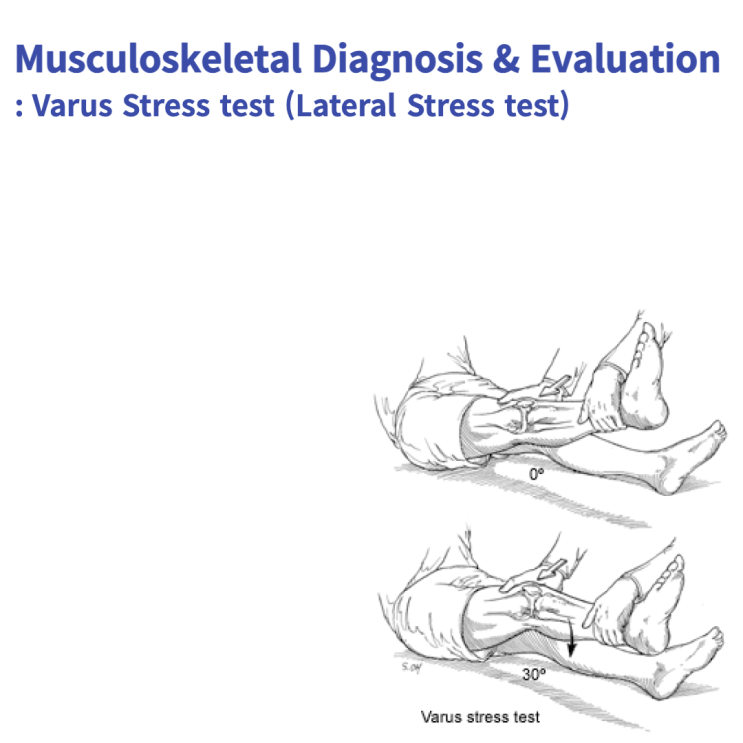 Varus Stress test (Lateral Stress test) - 안굽이 긴장 검사 (외측 스트레스 테스트) :무릎외측 ...