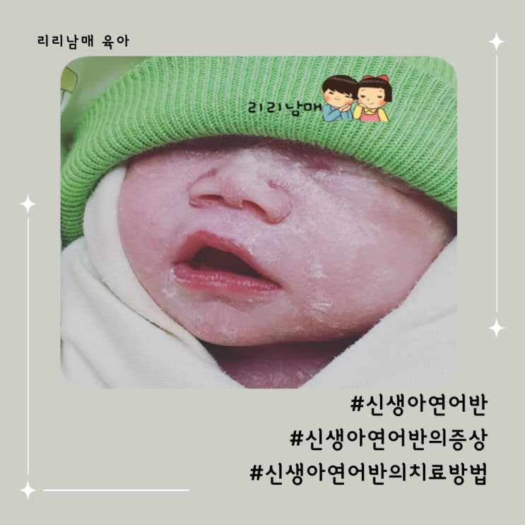 신생아 연어반 생기는 원인과 없어지는시기 네이버 블로그