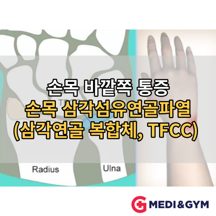 [울산 메디앤짐] 손목 삼각연골 복합체(Triangular Fibrocartilage Complex, TFCC)의 재활운동 과정 ...