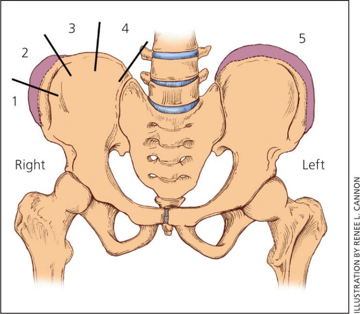 리서싸인(Risser sign), 골격의 성숙도(Osseous maturity)평가 : 네이버 블로그