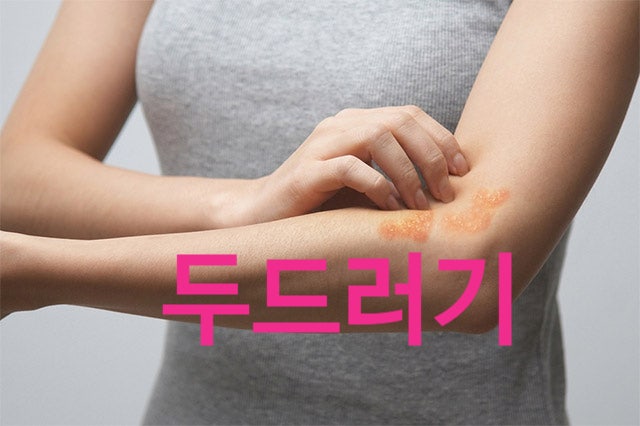 두드러기 증상 원인 알레르기 몸에 얼굴 만성 한랭 약 손등 전신 팔 피부 허벅지 콜린성 배 열 목뒤 응급처치 사타구니 연고 알기